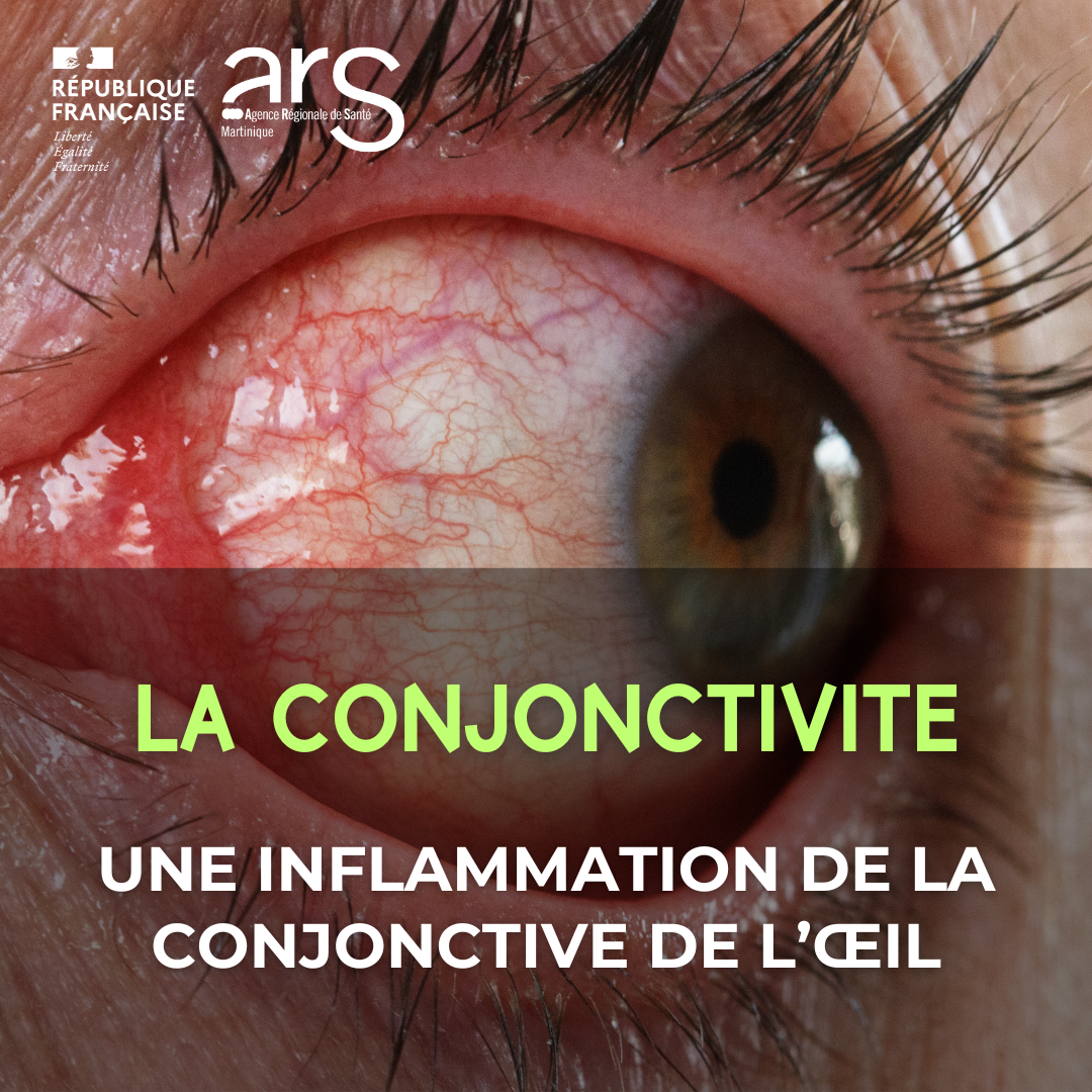 Comment reconnaître une conjonctivite ? | Agence régionale de santé ...